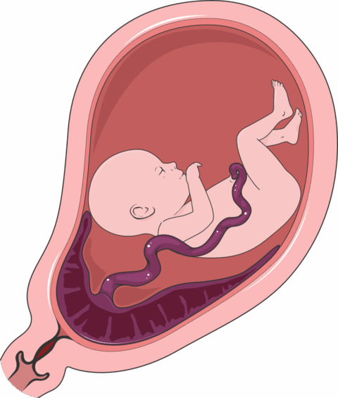 Placenta previa en el embarazo - Clínica Trotula Ruggiero